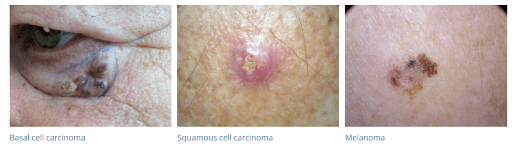 Squamous Cell Skin Cancer Squamous Cell Carcinoma Of The Skin