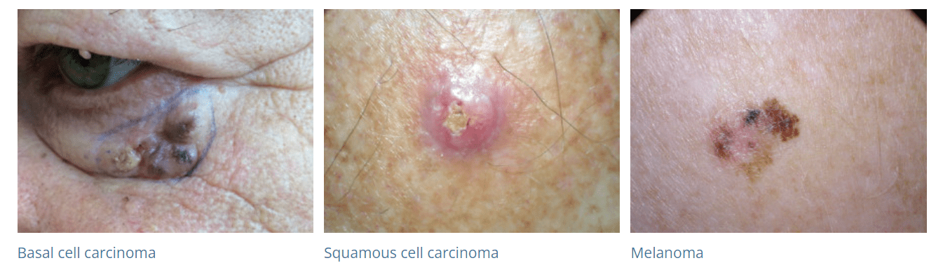 Symptoms of Skin Cancer & Treatment | Three Kings Accident & Medical Clinic